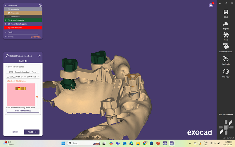 Straumann EXACT™ workflow: a landmark in digital full-arch